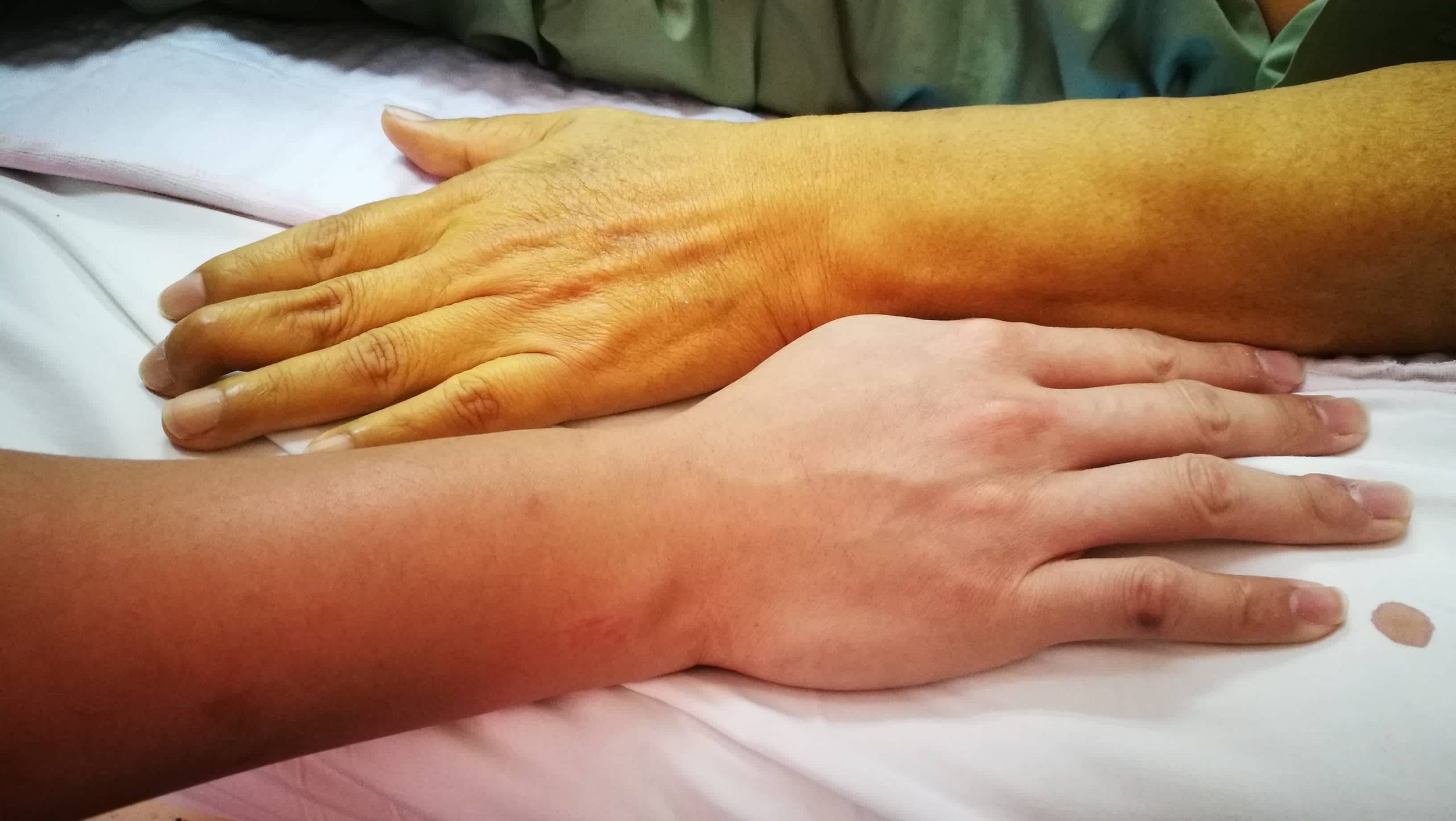 Jaundice Yellow Skin - FAQs
