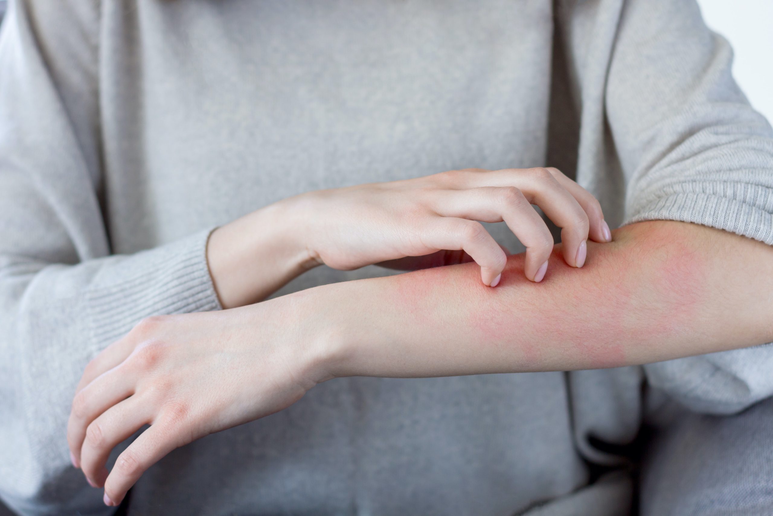 Types of Skin Allergies and Treatment - FAQs