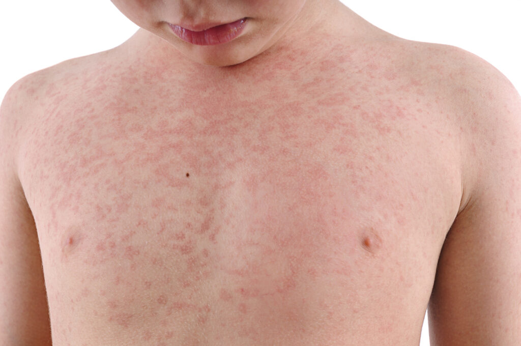 Skin Rashes and What to Do About Them - FAQs